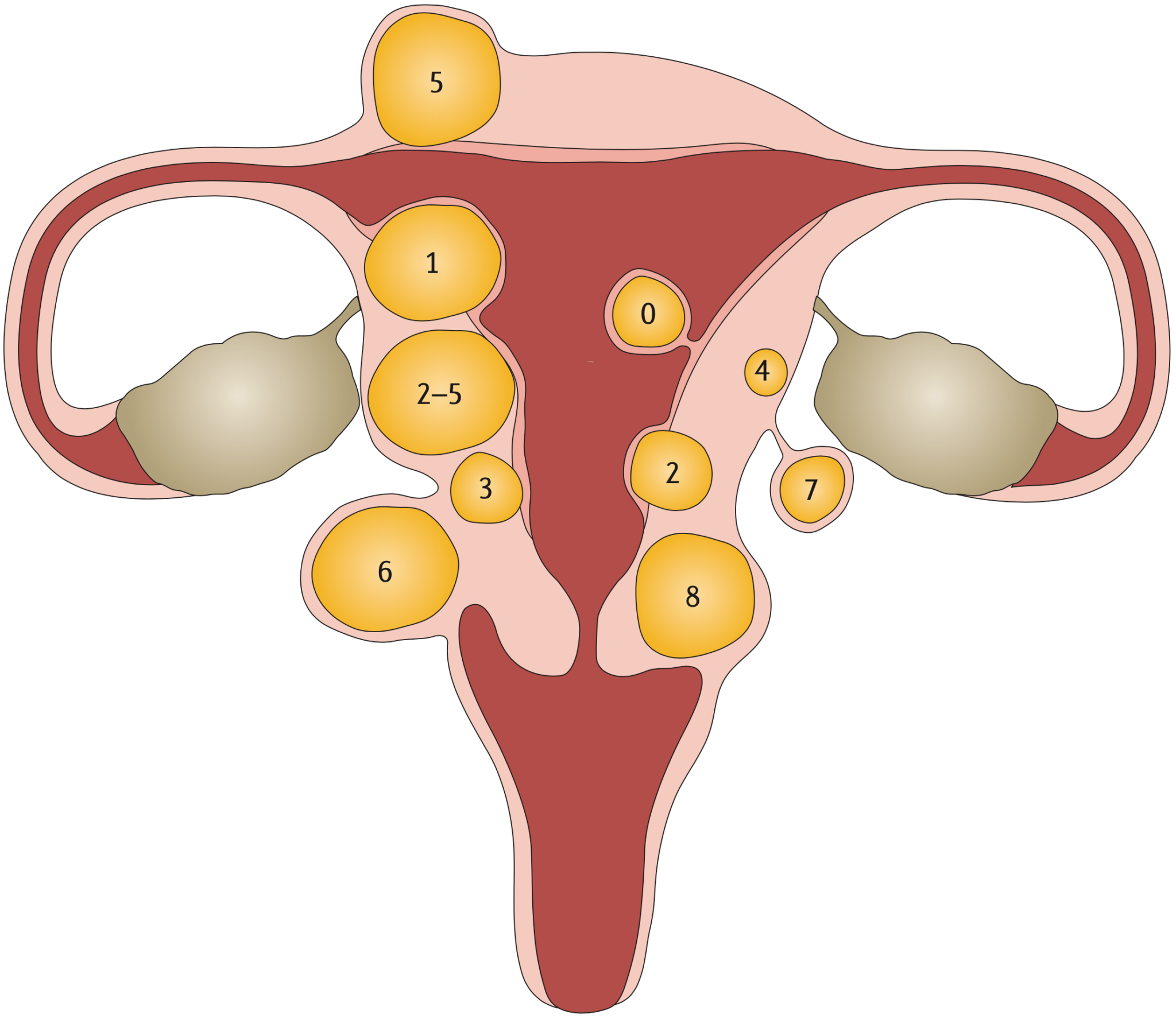 Fibroids – Gynelogic